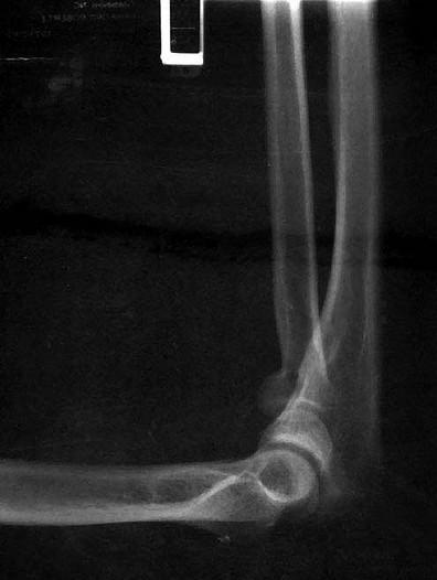 What is Golfer's Elbow? (with pictures)